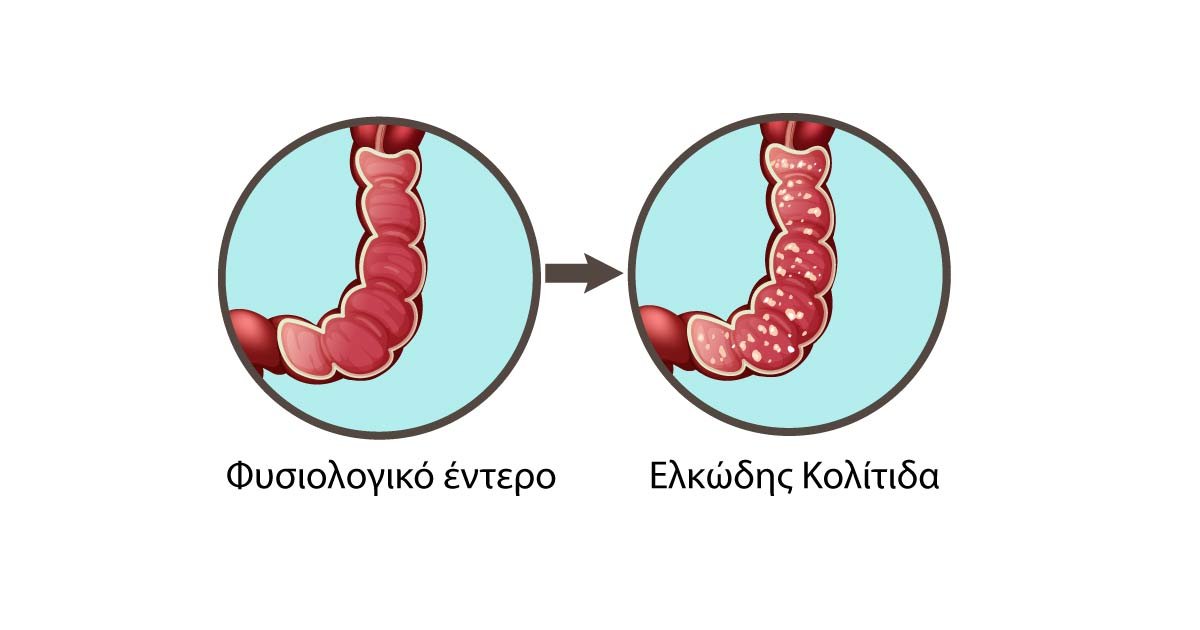 Ελκώδης Κολίτιδα: Τι Είναι και Πώς Αντιμετωπίζεται